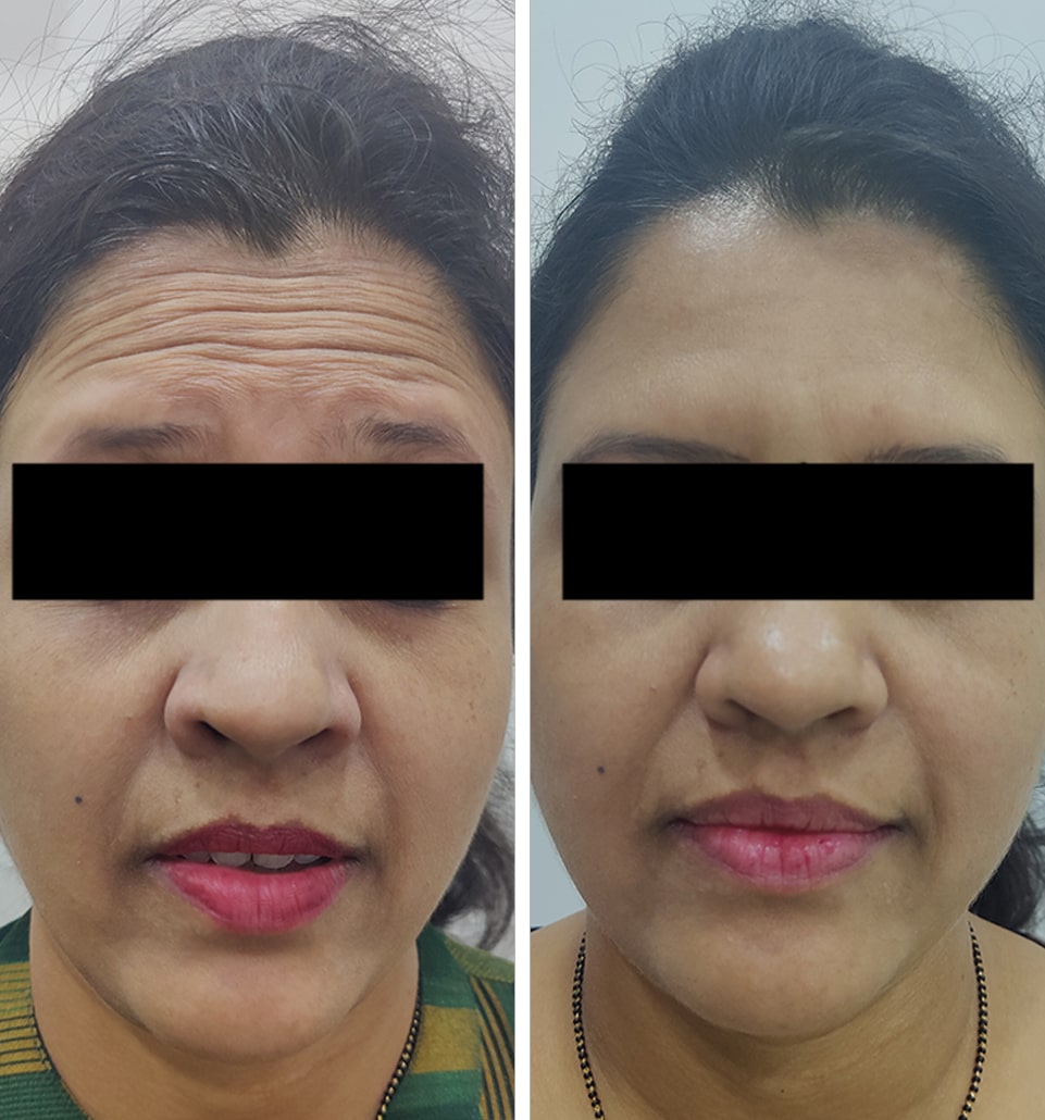 Wrinkle Reduction Treatments In Kandivali Borivali And Malad