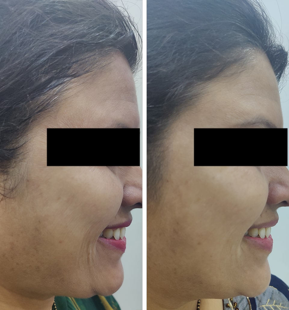 Wrinkle Reduction Treatments In Kandivali Borivali And Malad